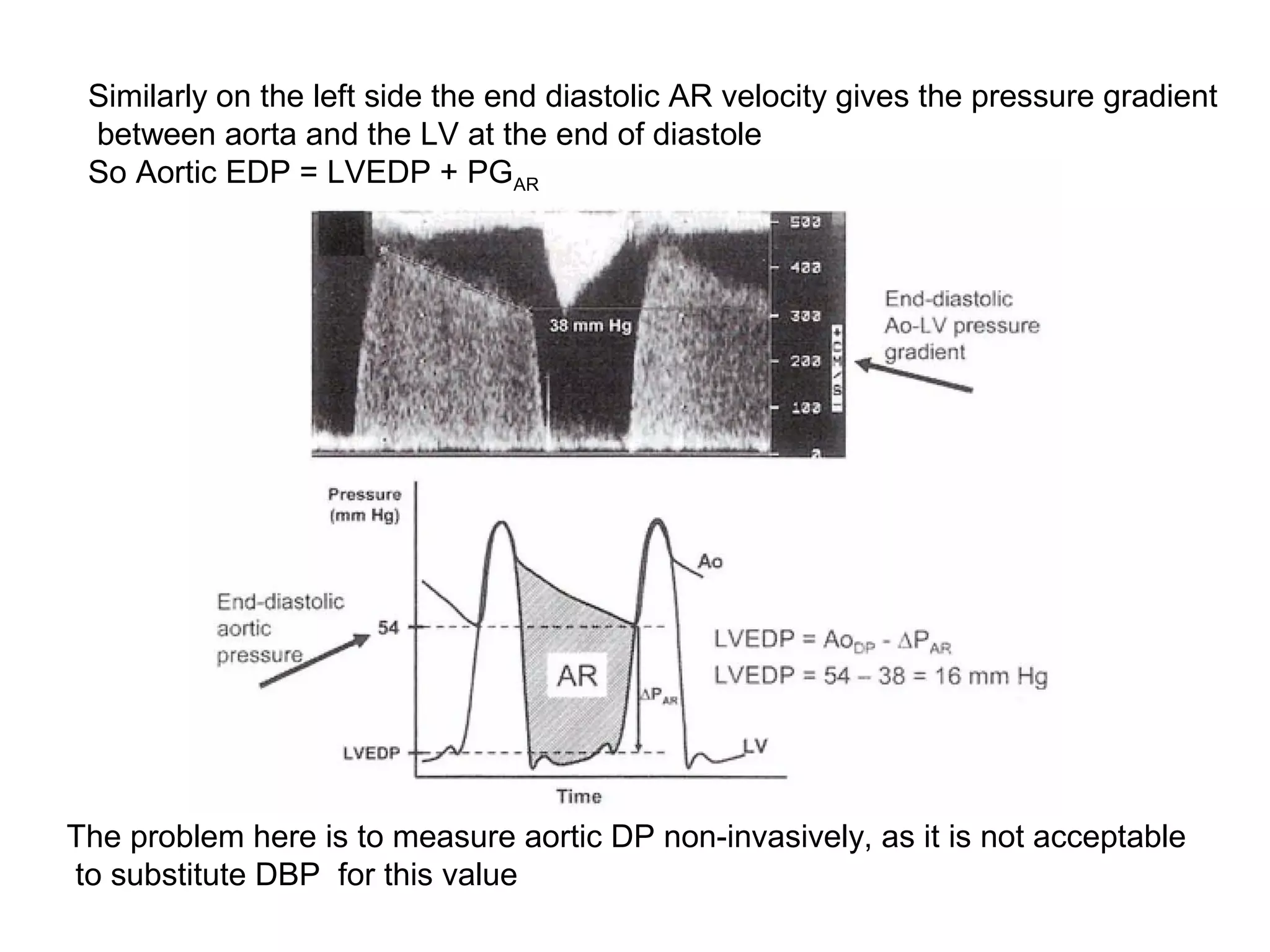 Hemodynamic Assessment by Echocardiography | PPT
