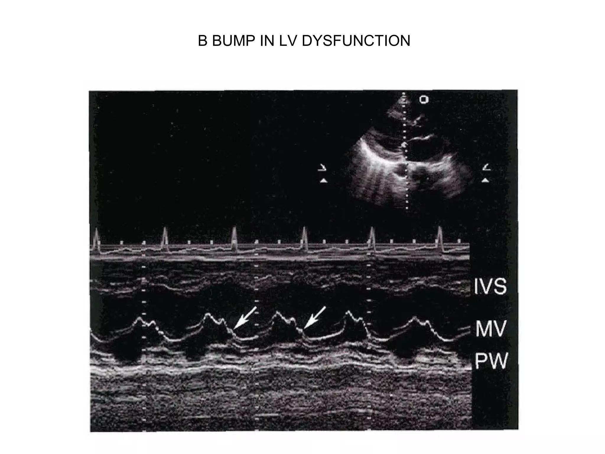 Hemodynamic Assessment by Echocardiography | PPT