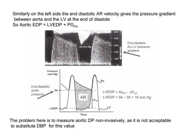 Hemodynamic Assessment by Echocardiography | PPT