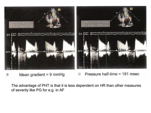 Hemodynamic Assessment by Echocardiography | PPT