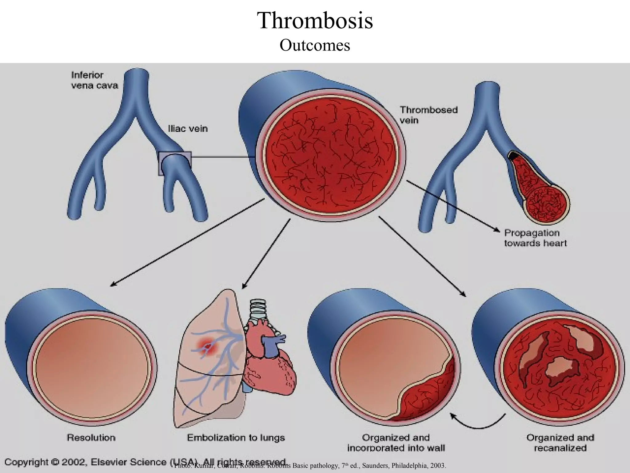 Hemodynamic disorders, thrombosis and shock (practical pathology) | PPT