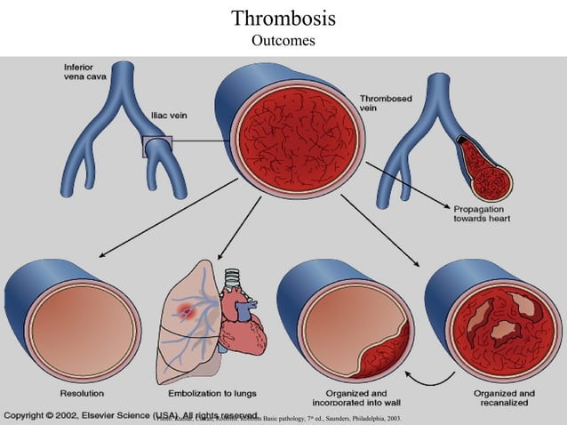 Hemodynamic disorders, thrombosis and shock (practical pathology) | PPT
