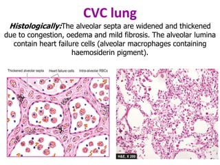 Hemodynamic disorders - Lecture-5 | PPTX