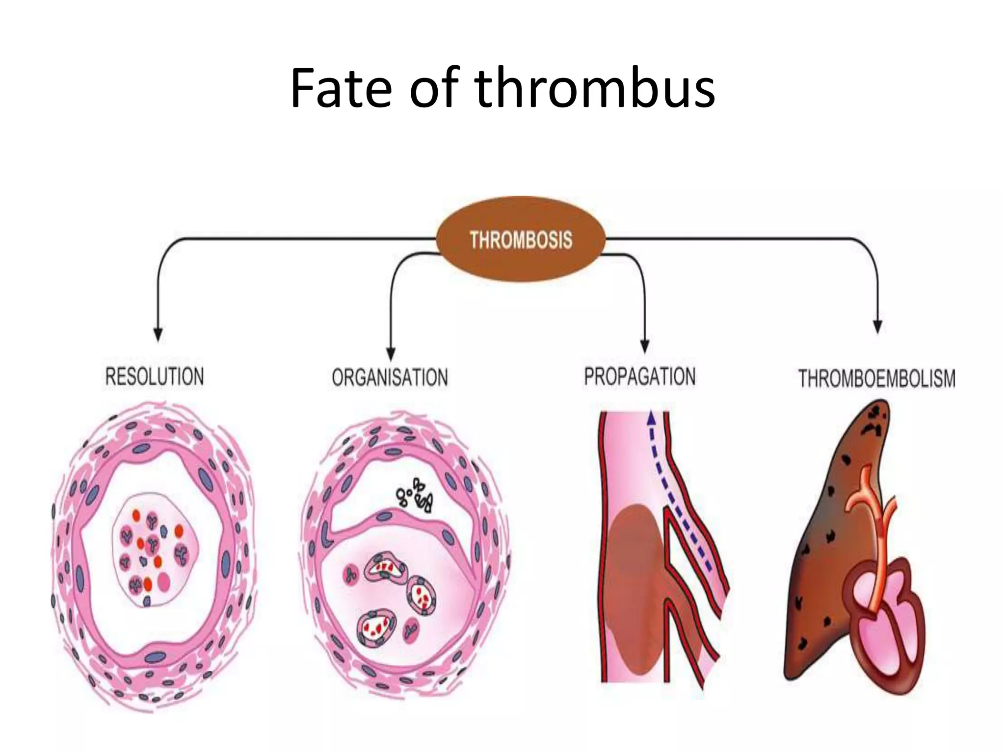 Hemodynamic Disorders, Thromboembolic Disease & Shock-HYPERCOAGULABLE ...