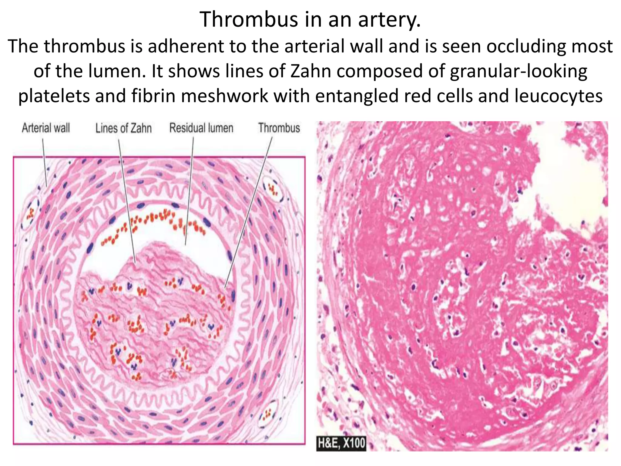 Hemodynamic Disorders, Thromboembolic Disease & Shock-HYPERCOAGULABLE ...