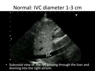 HEMODYNAMICS MONITORING IN CRITICALLY ILL PATIENTS: ASSESSMENT OF FLUID ...