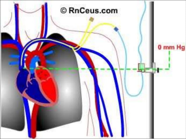 Hemodynamic monitoring ppt | PPTX | First Aid | Injuries