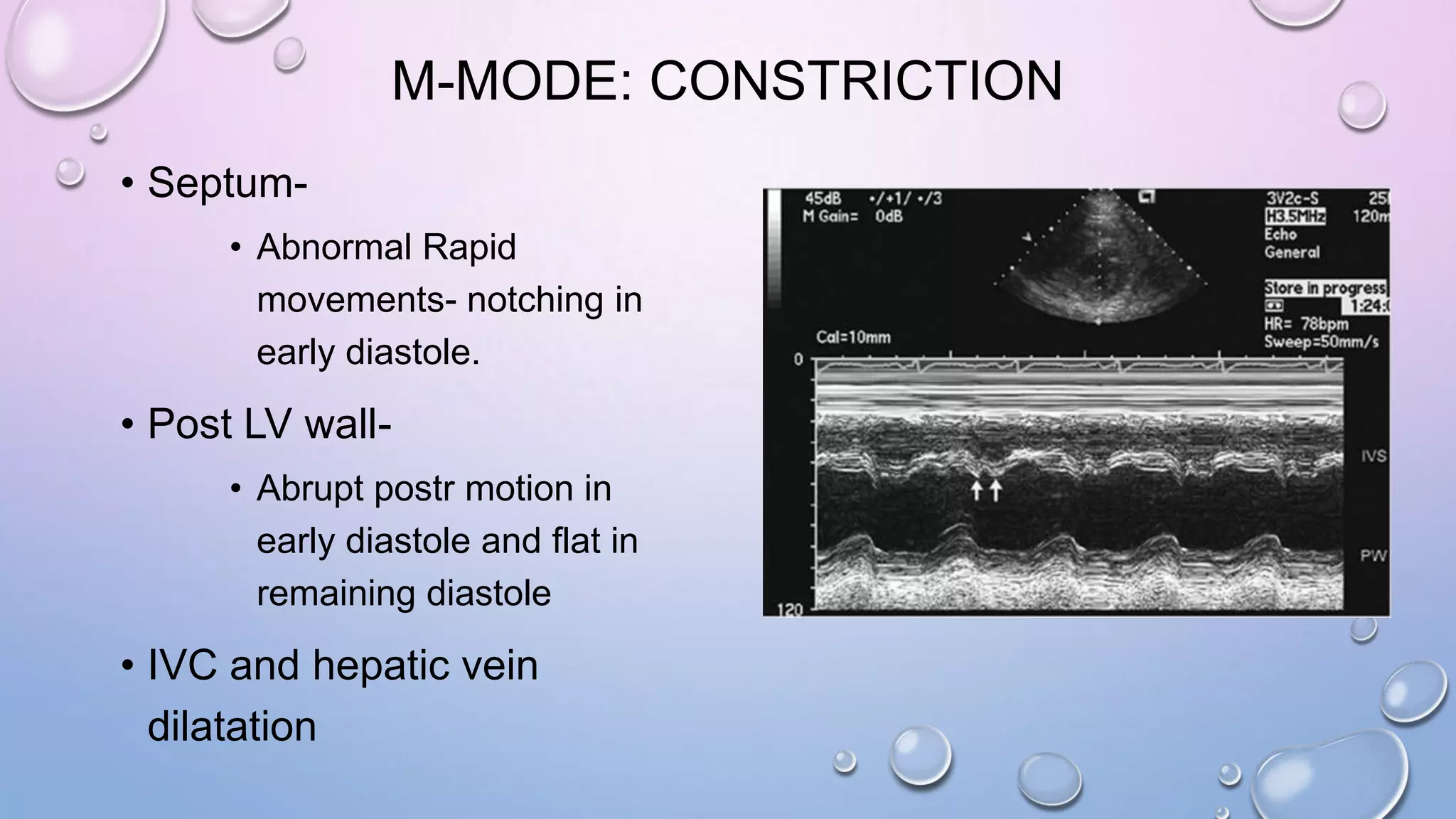 Hemodynamics of cardiac tamponade, constrictive pericarditis ...