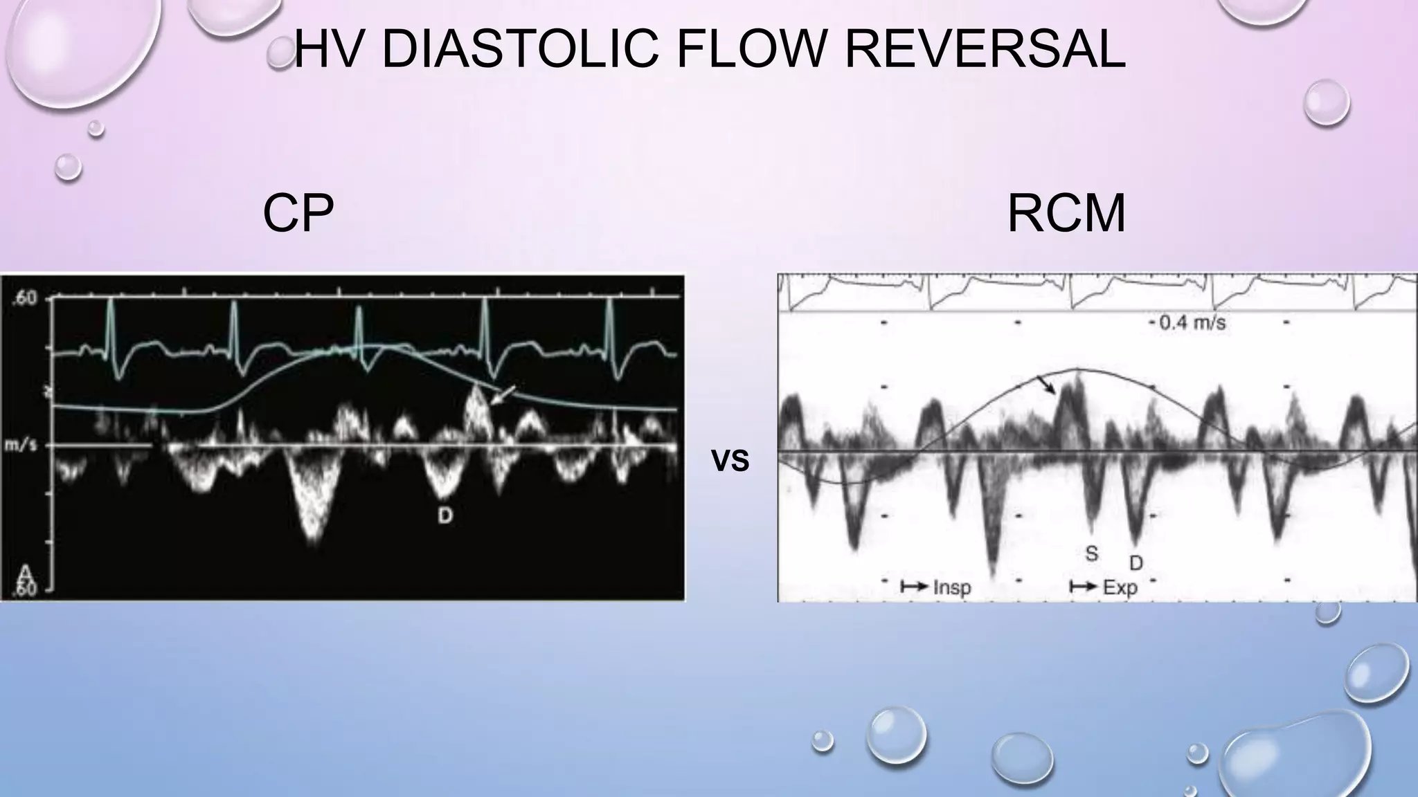 Hemodynamics of cardiac tamponade, constrictive pericarditis ...