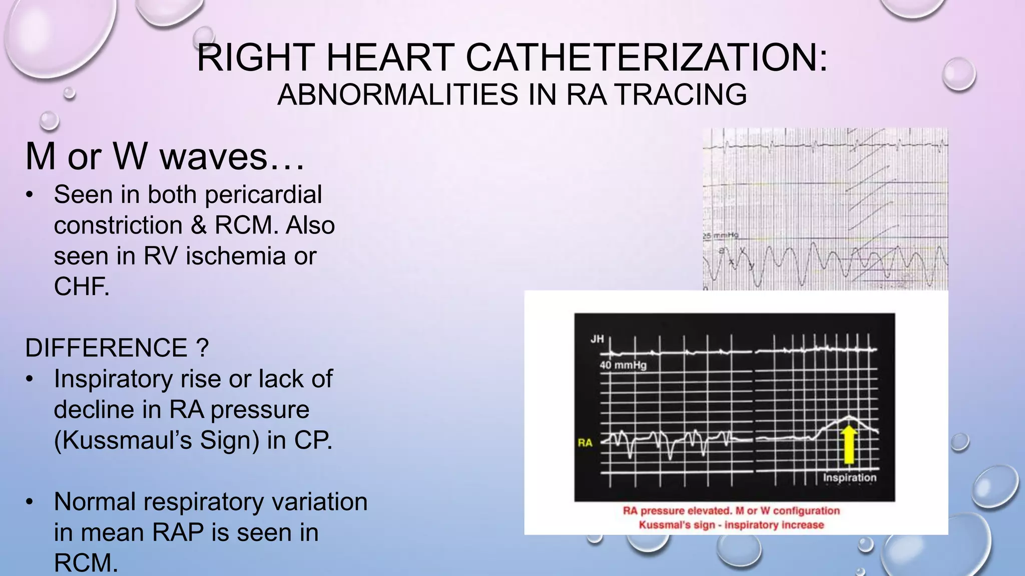 Hemodynamics of cardiac tamponade, constrictive pericarditis ...