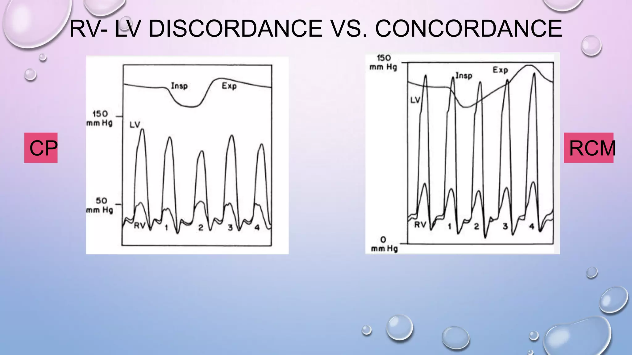 Hemodynamics of cardiac tamponade, constrictive pericarditis ...