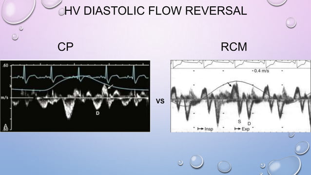 Hemodynamics of cardiac tamponade, constrictive pericarditis ...