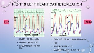 Constrictive Pericarditis Hemodynamics