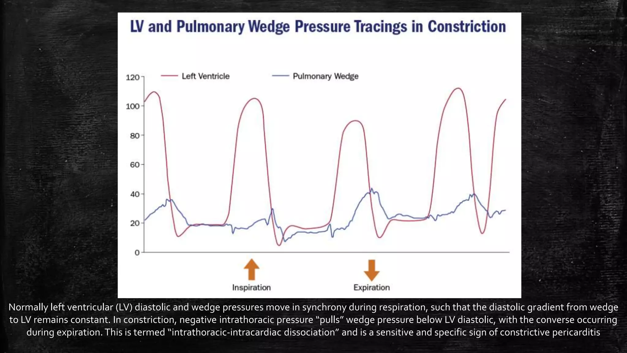 Hemodynamics of pericardial constriction | PPTX