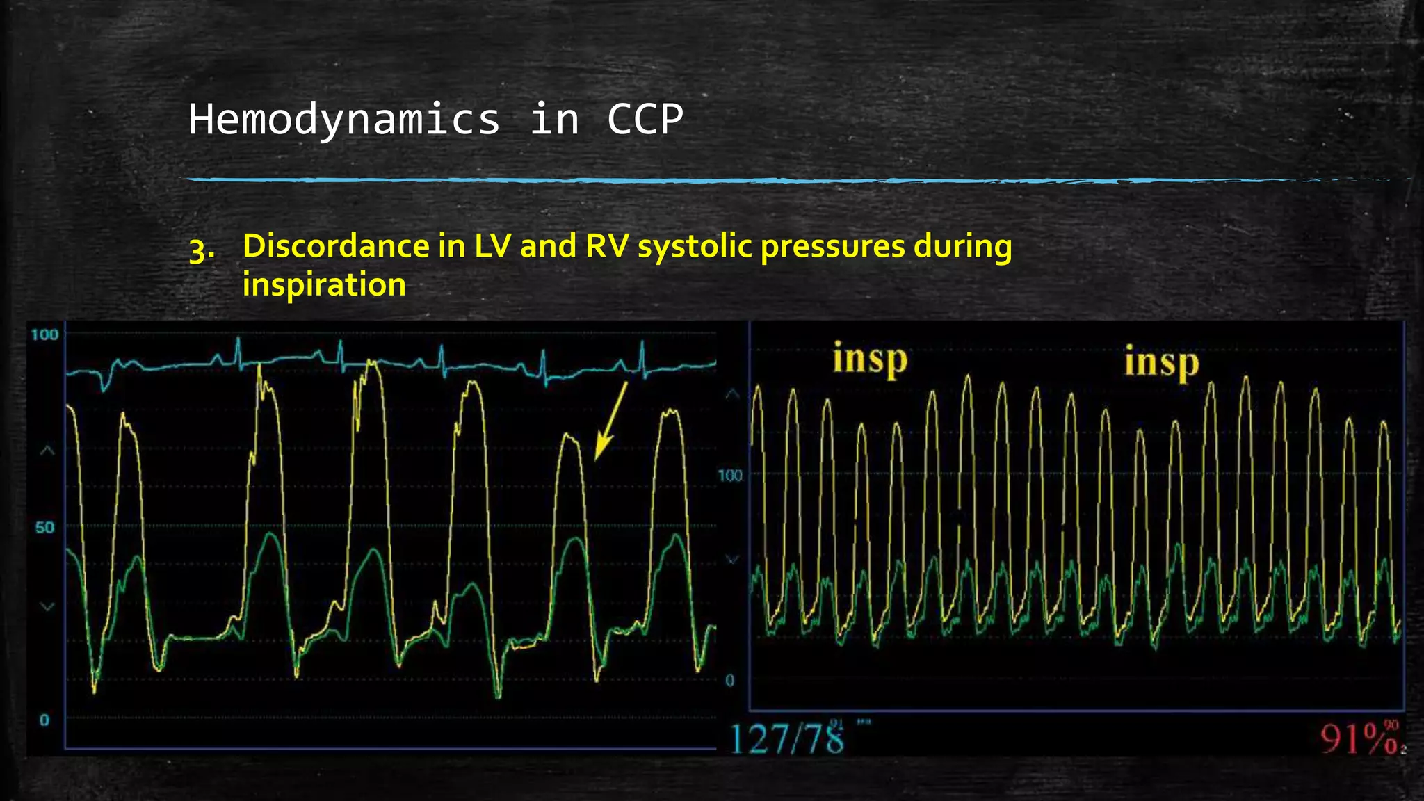 Hemodynamics of pericardial constriction | PPTX