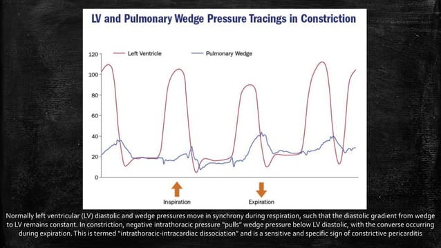 Hemodynamics of pericardial constriction | PPTX | Heart and ...
