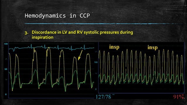 Hemodynamics of pericardial constriction | PPTX | Heart and ...