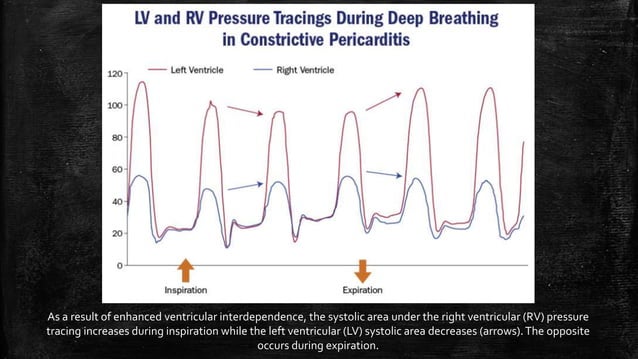 Hemodynamics of pericardial constriction | PPTX | Heart and ...