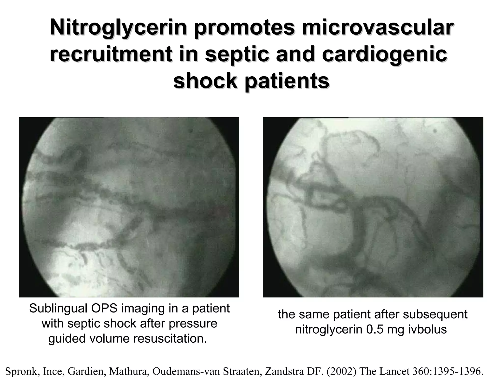 Hemodynamic Stabilisation In Septic Shock | PPT