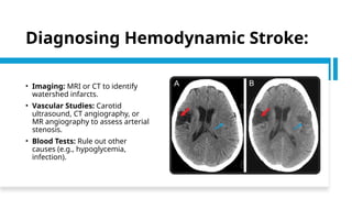 Neurology Hemodynamic stroke brain stroke | PPTX