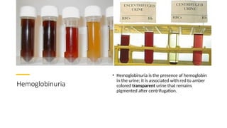 Hemoglobinemia and hemoglobinuria in biochemistry | PPTX