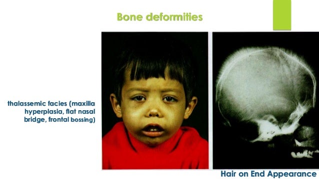Thalassemia and Hemoglobinopathies
