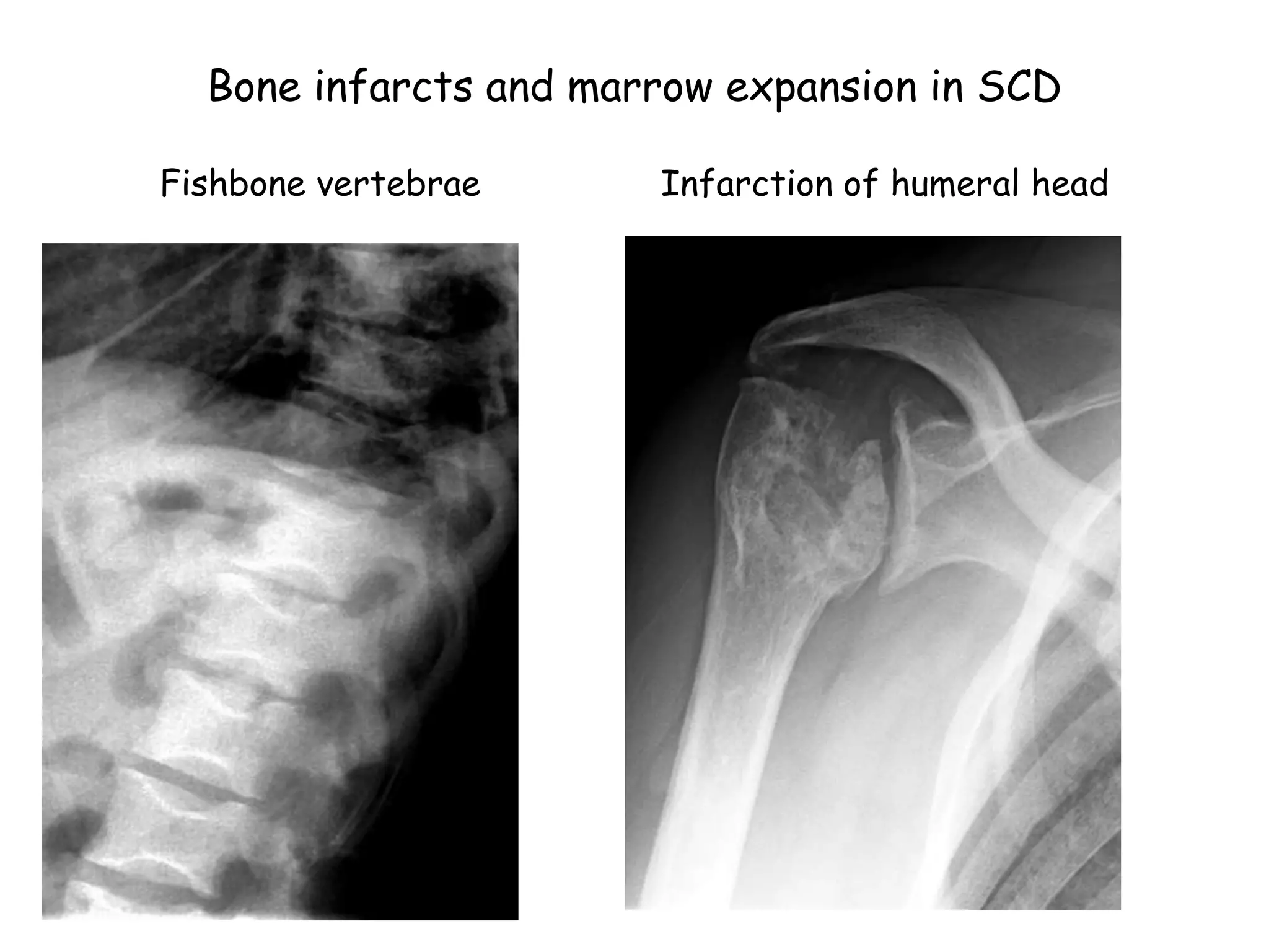 Hemoglobinopathies - Oct 2014 | PPTX