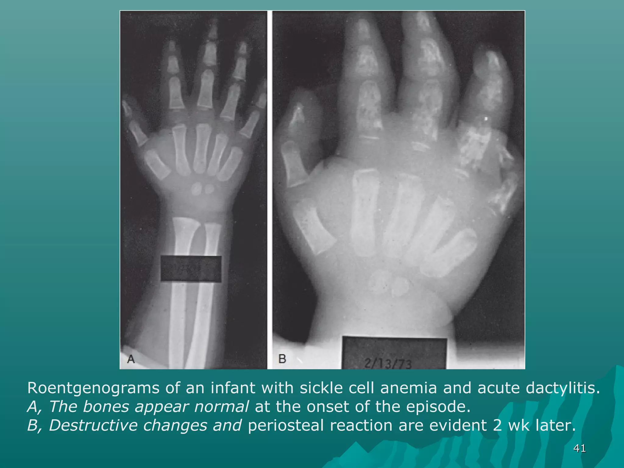 Hemoglobinopathies | PPT