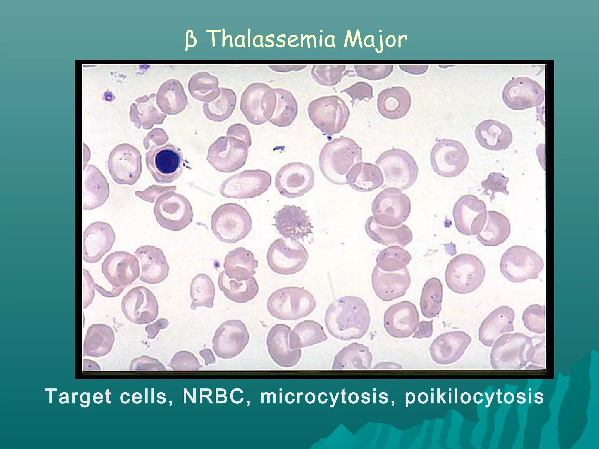 Hemoglobinopathies | PPT
