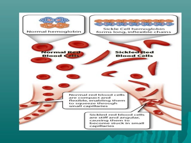 Hemoglobinopathies | PPT