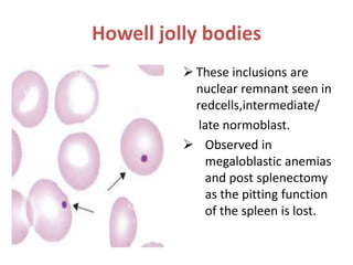Hemoglobinopathy -sickle cell anemia | PPTX