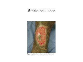 Hemoglobinopathy & sickle cell disease | PPT