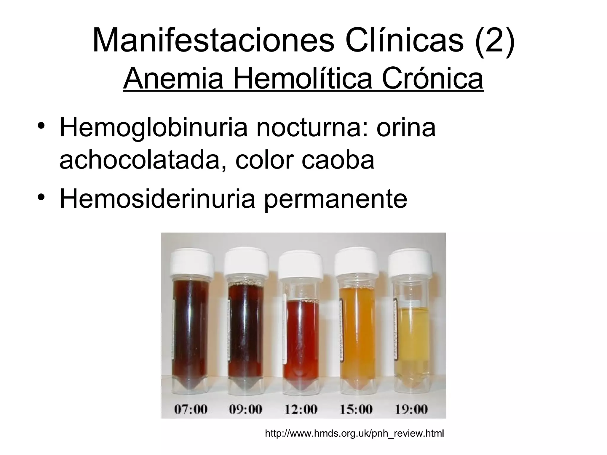 Hemoglobinuria Paroxistica Nocturna | PPT | Blood Disorders | Diseases ...