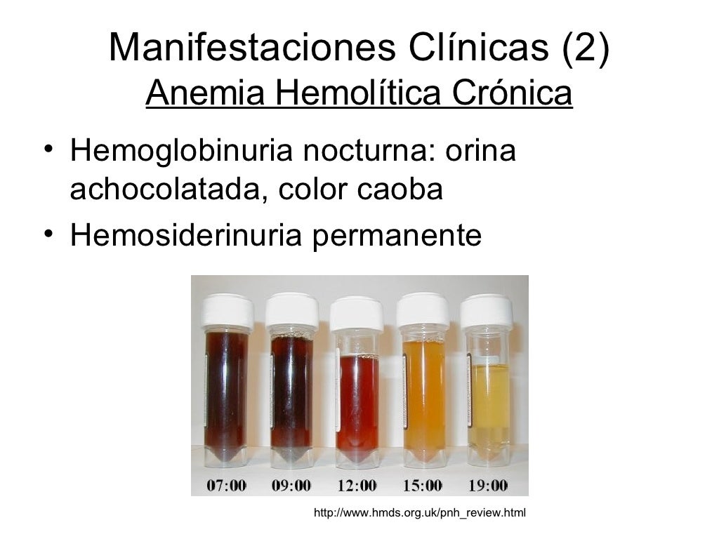 Hemoglobinuria Paroxistica Nocturna
