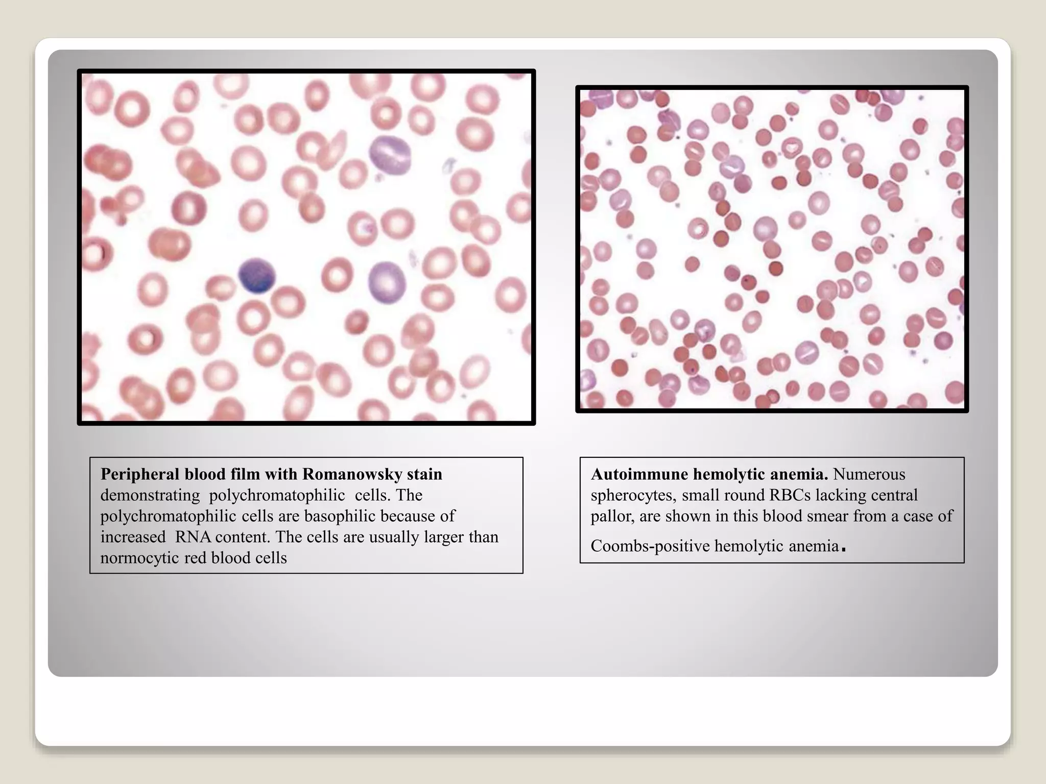 Hemolyic Anemia ppt | PPTX