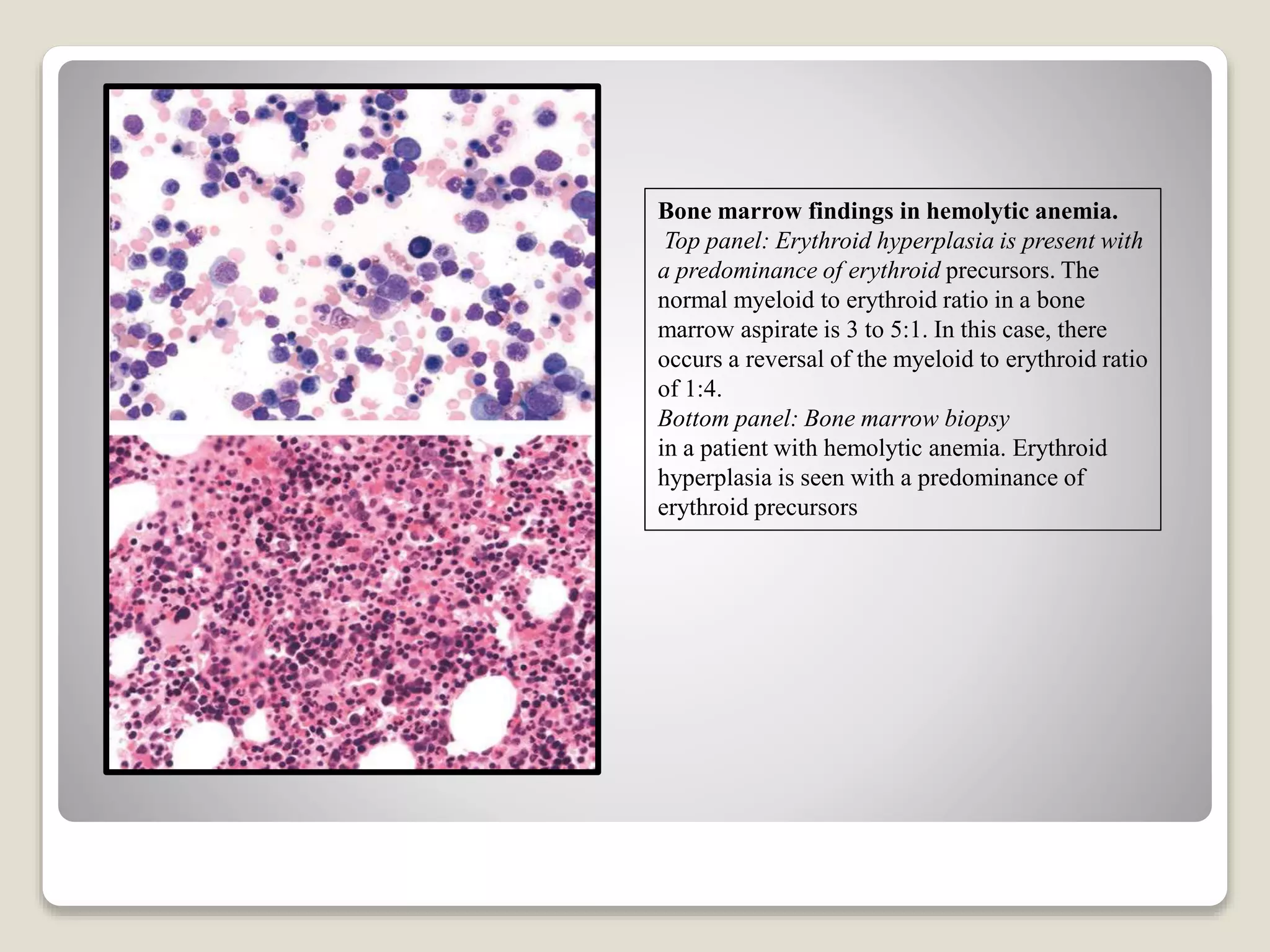 Hemolyic Anemia ppt | PPTX