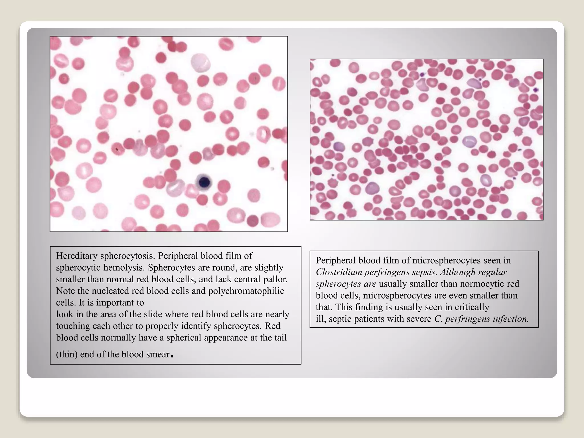 Hemolyic Anemia ppt | PPTX
