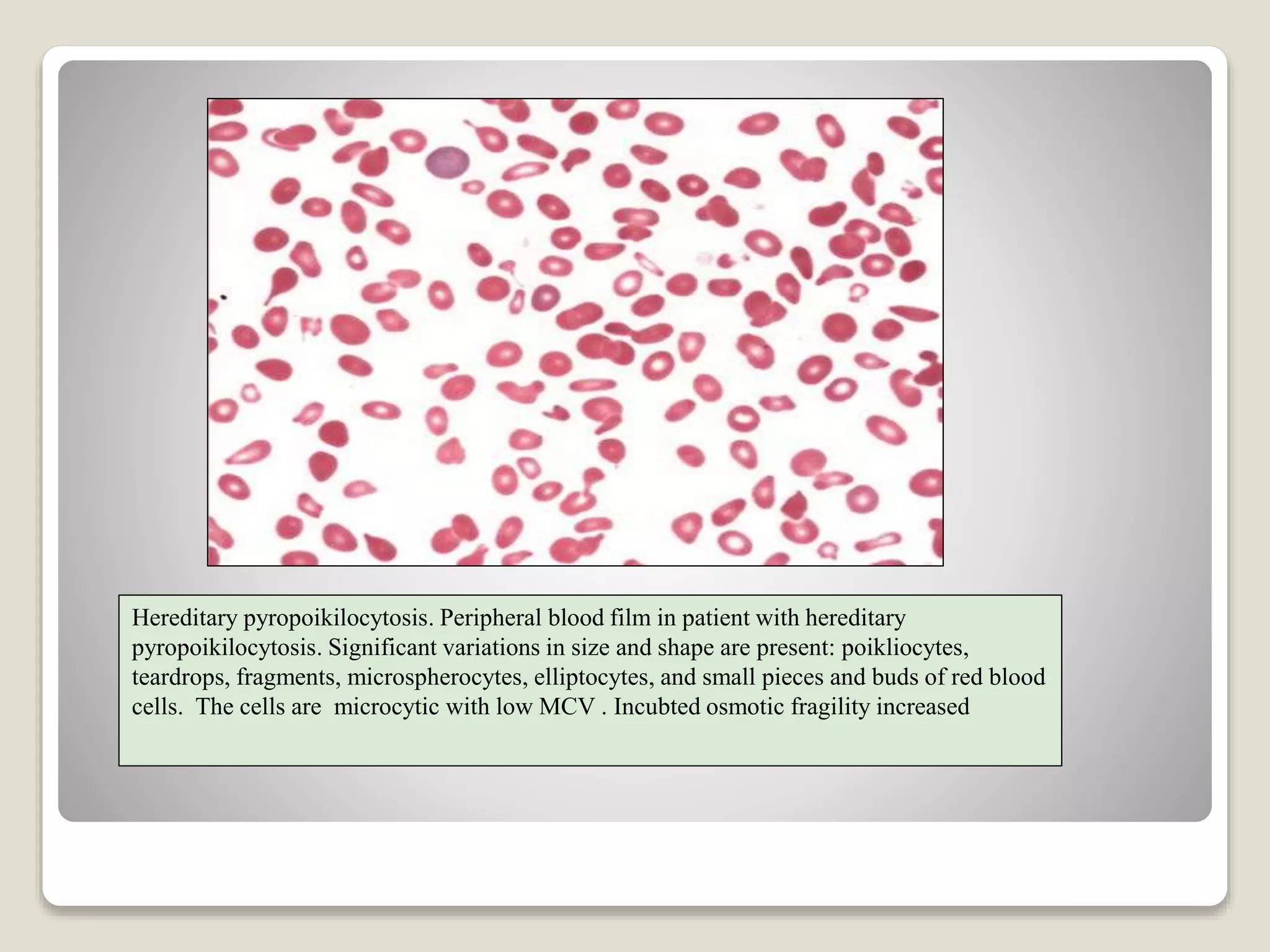 Hemolyic Anemia ppt | PPTX