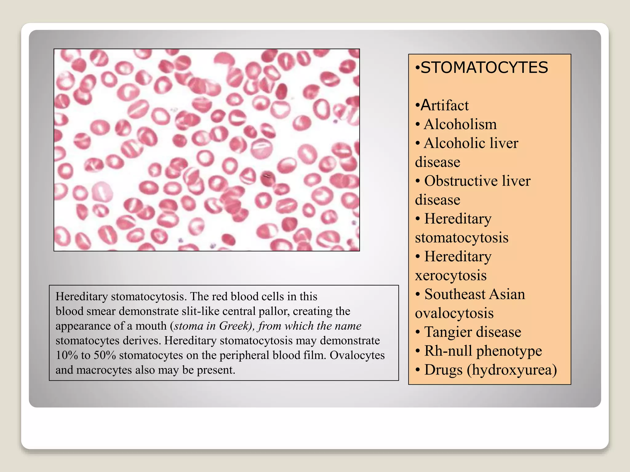 Hemolyic Anemia ppt | PPTX