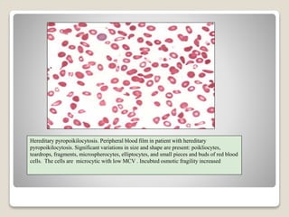 Hemolyic Anemia ppt | PPTX