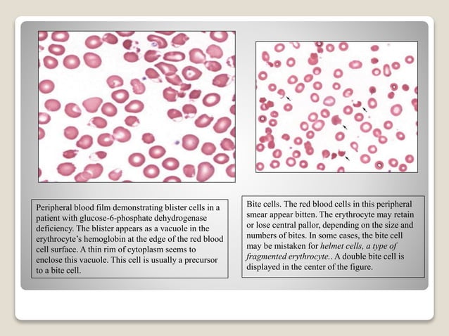 Hemolyic Anemia ppt | PPTX
