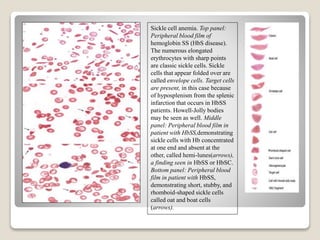 Hemolyic Anemia ppt | PPTX
