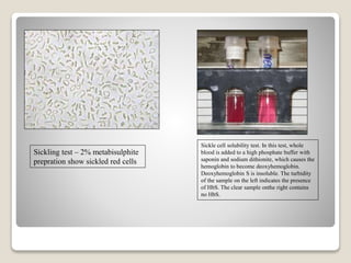 Hemolyic Anemia ppt | PPTX