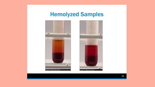 Hemolysis | PPTX