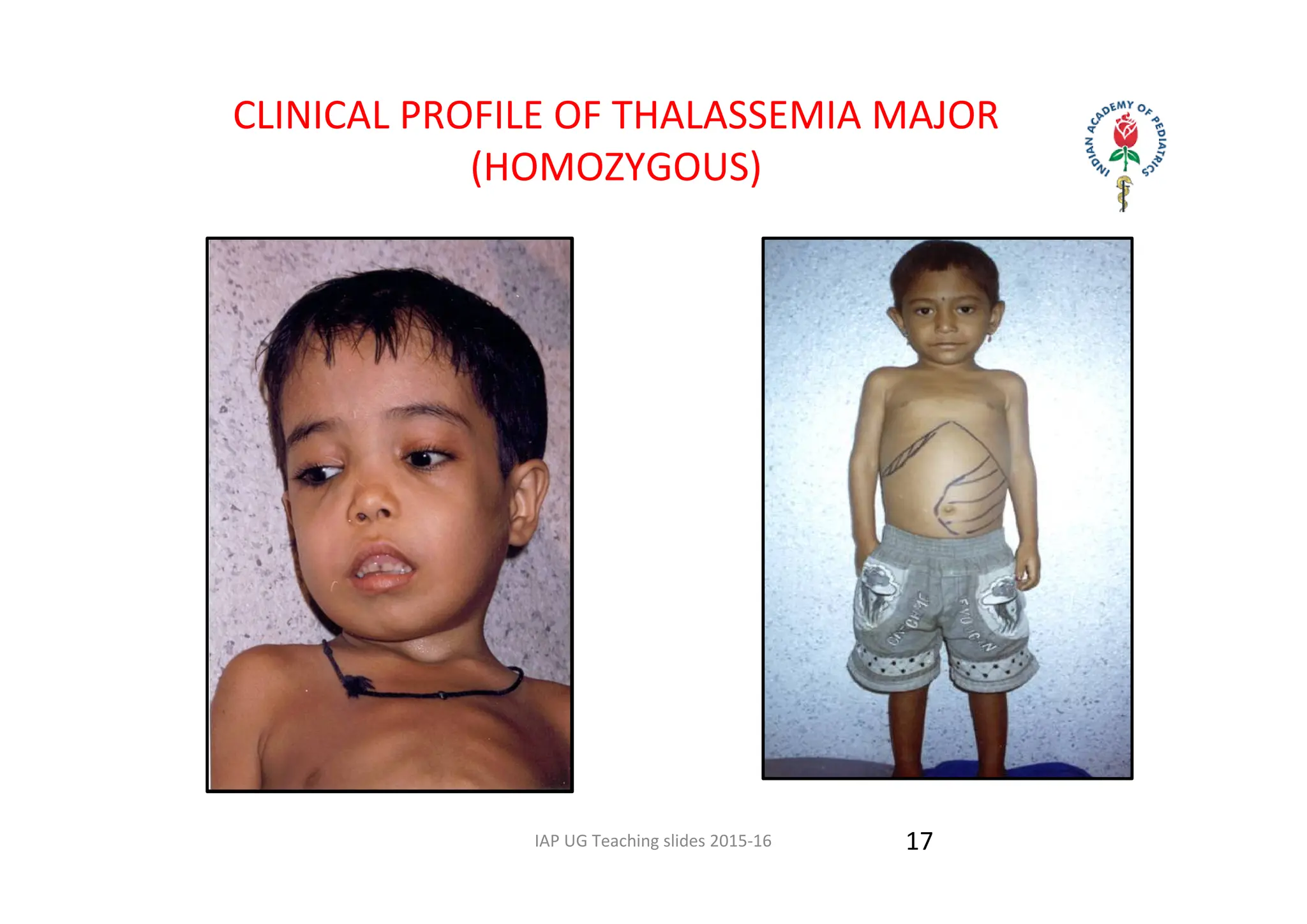 Hemolytic-Anemia in pediatric population | PDF