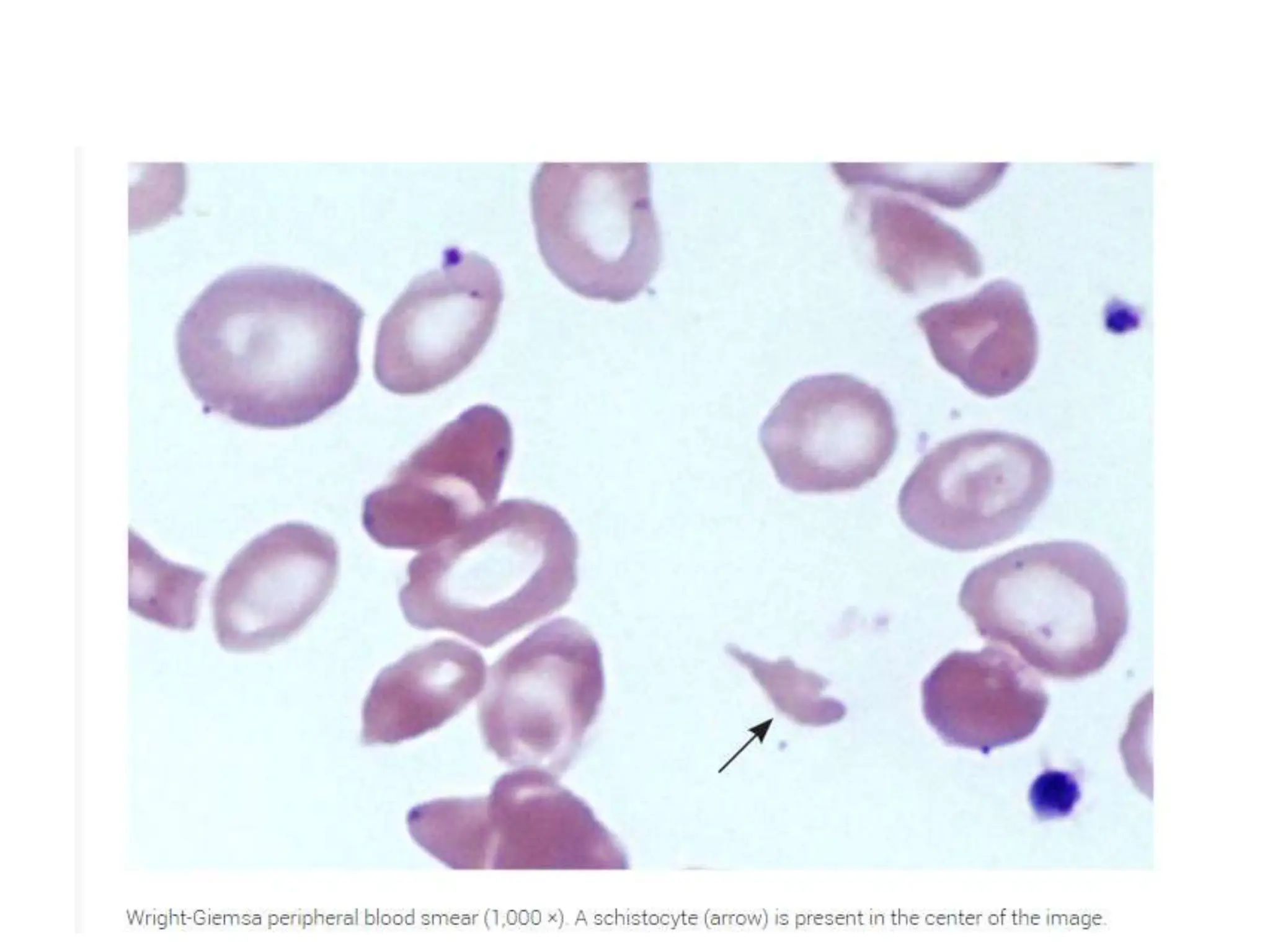 Hemolytic-uremic syndrome (HUS). important pptx | PPTX