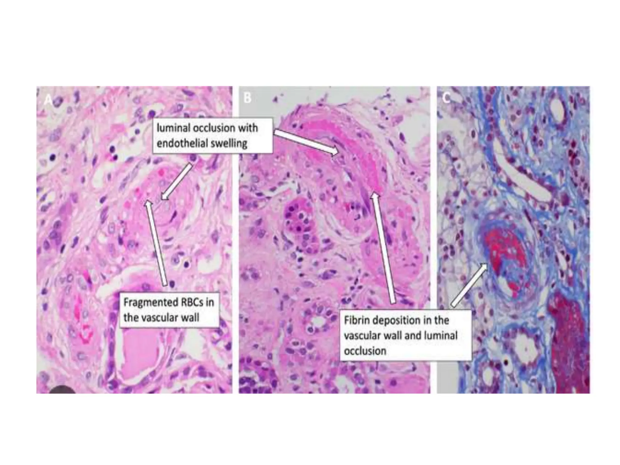 Hemolytic-uremic syndrome (HUS). important pptx | PPTX