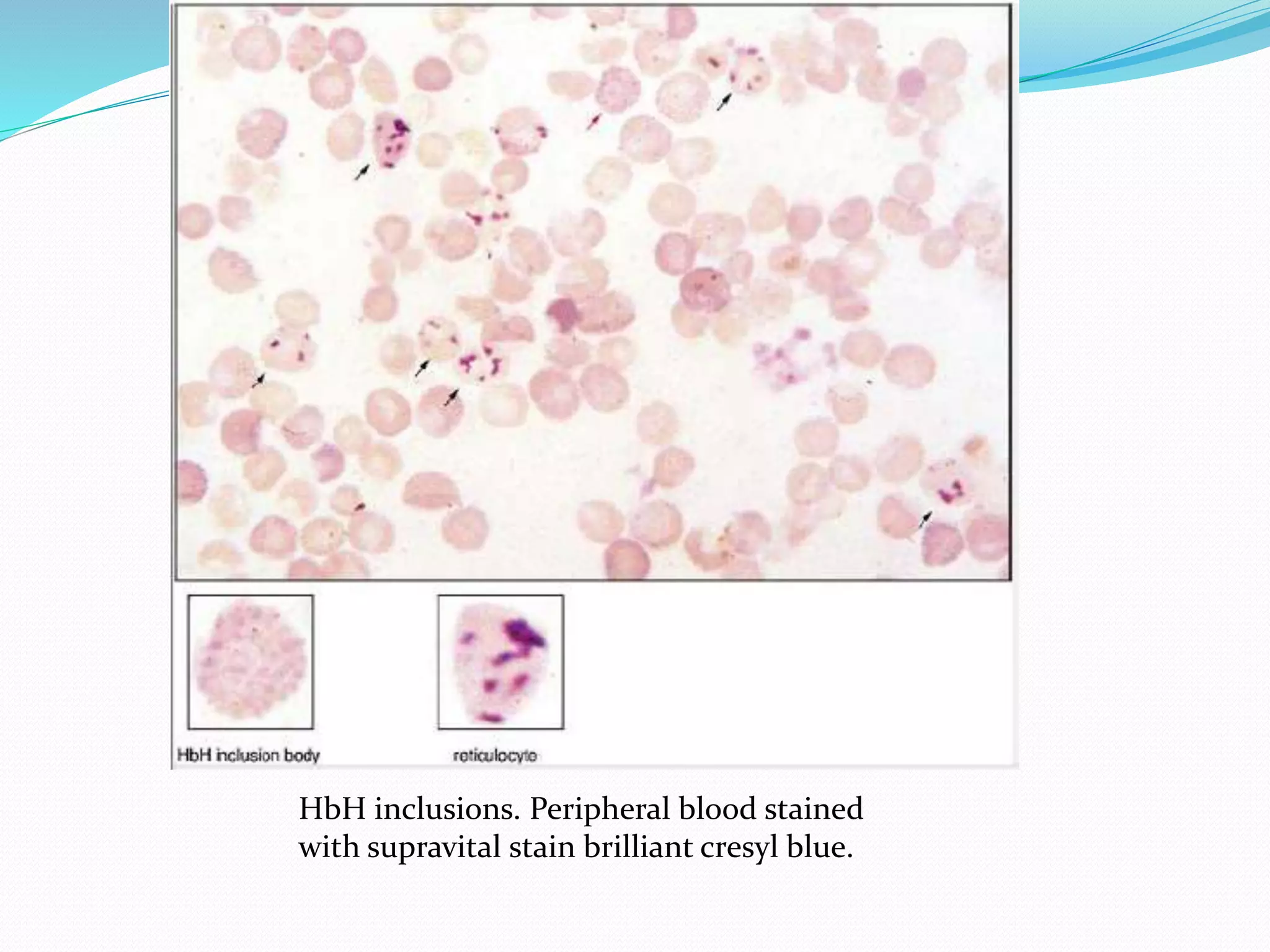 An Overview of Hemolytic anemia | PPTX