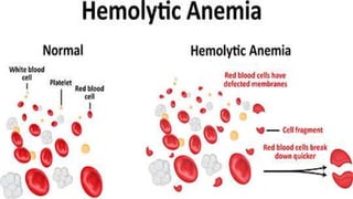 Hemolytic anemia | PPTX