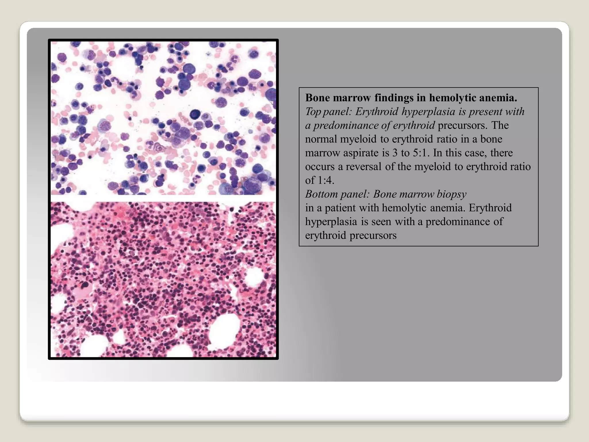 Hemolytic anemia | PDF